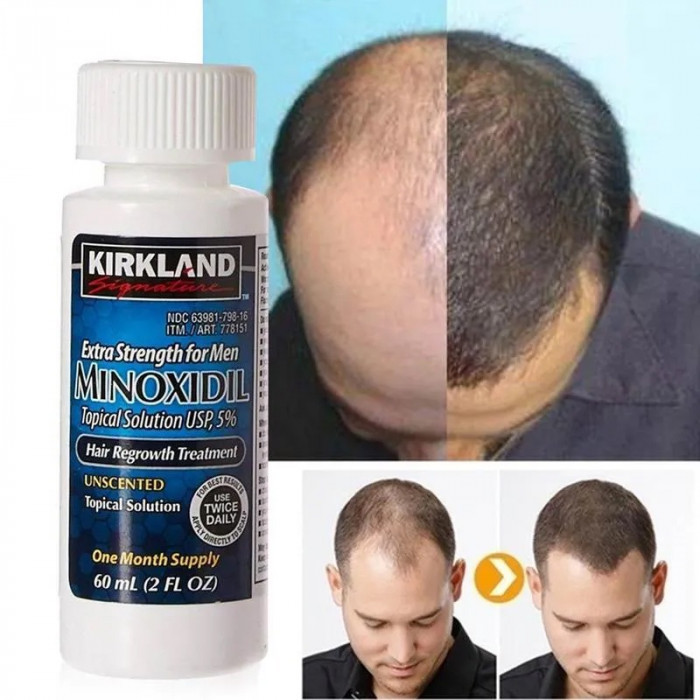 Kirkland Signature 6 Months Kirkland Minoxidil 5% Extra Strength Hair ...