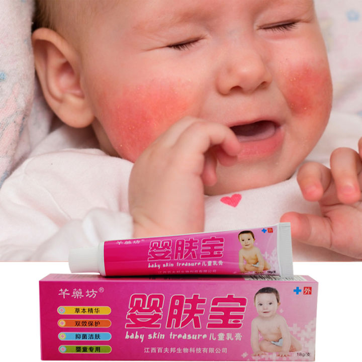 Eczema Cream baby krim gatal antifungal cream Nappy cream baby ...
