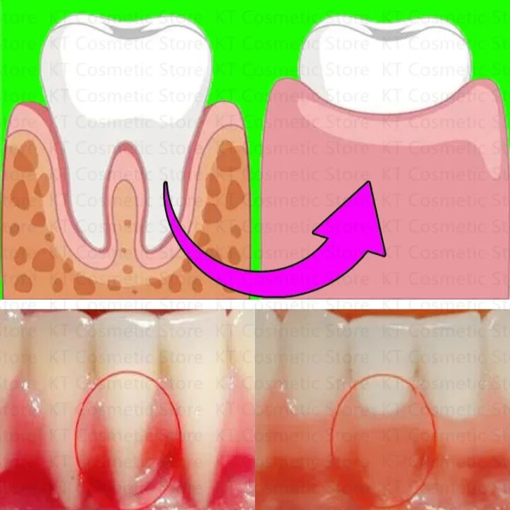 Rapid Damaged Gum Repair Care Serum Relieve Tooth Allergy Dental Caries ...