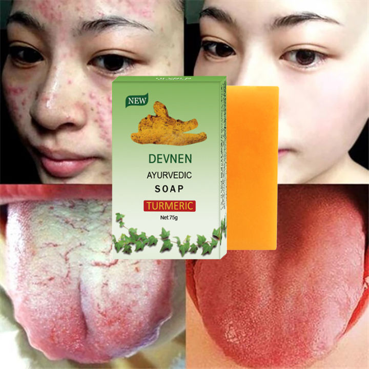 Original Turmeric Soap 75G Legit and Authentic Whitening Soap, Acne ...