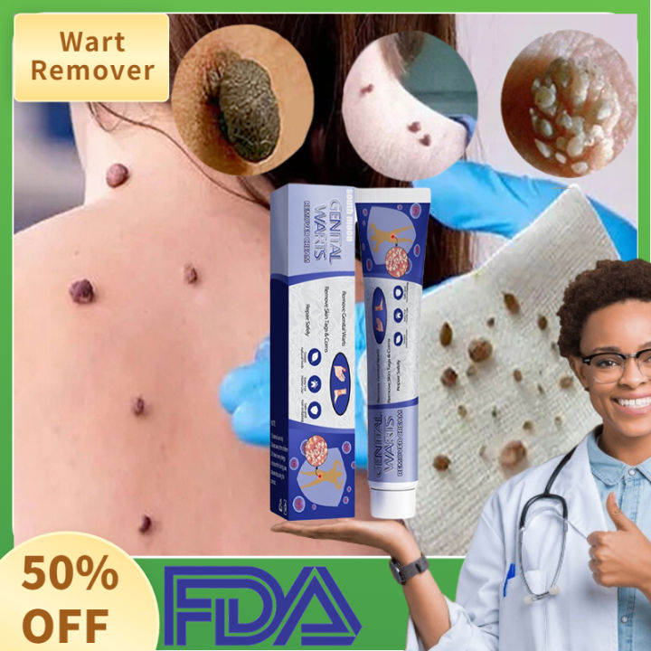 Warts Remover Cream Warts Magic Remover Wart Ointment Warts Remover ...