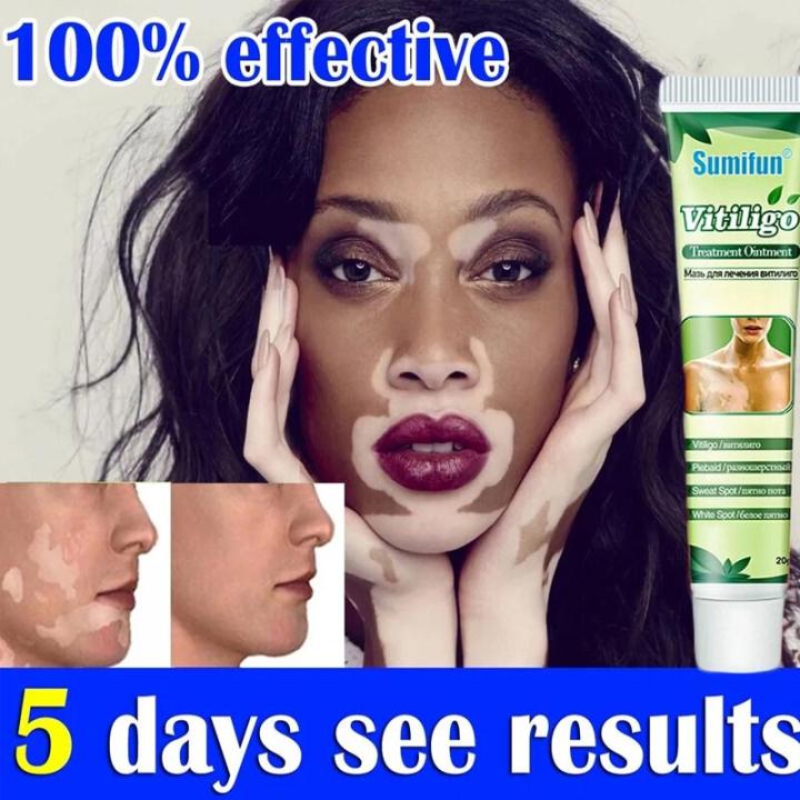 Big savings White spot cream vitiligo white spots pigmentation 20g ...