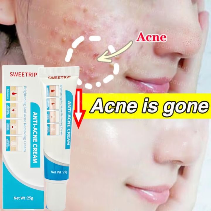 100% Effective Remove Pimples Anti-Acne Treatment Gel Quickly Pimple Remover Acne Cream Fades ...