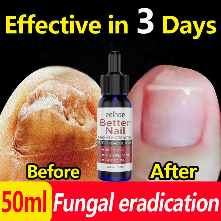 🔥3 Days Remove Onychomycosis🔥Nail Repair Essence 50ml Inhibit Fungal ...