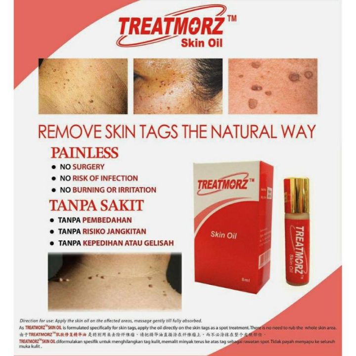 Ready-made inventory Treatmorz Skin Oil Skin Tags Removal Merawat Kutil ...