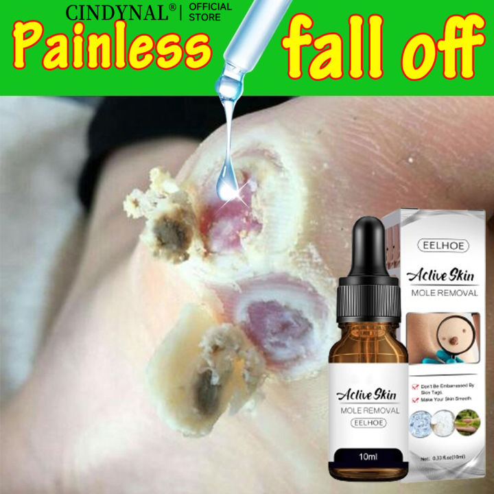 CINDYNAL Organic Oil Warts Remover Skin Tags Remover, Mole Remover ...