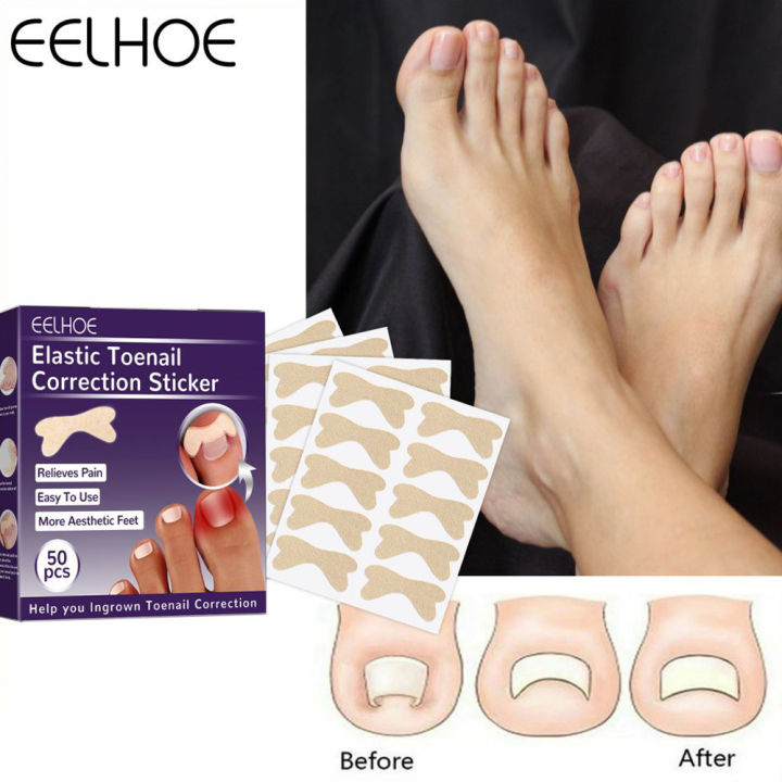Eelhoe Elastic Toenail Correction Stickers Ingrown Toenail Corrector ...