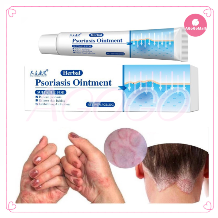 100% Original Authentic Eczema Cream Psoriasis Dermatitis Ointment ...