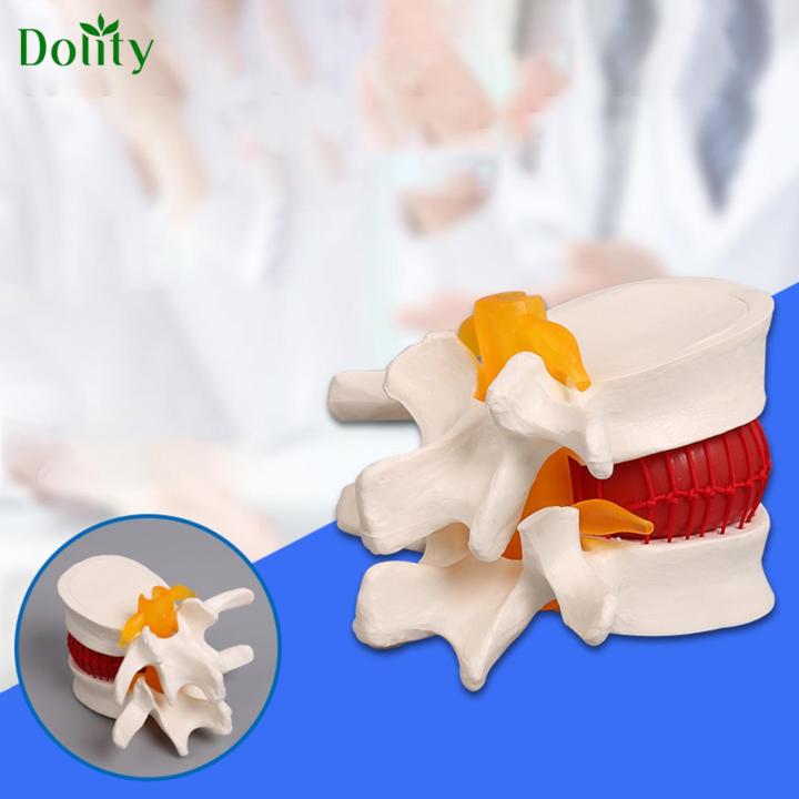 Dolity Anatomical Lumbar Disc Herniation Model Disc Herniation ...