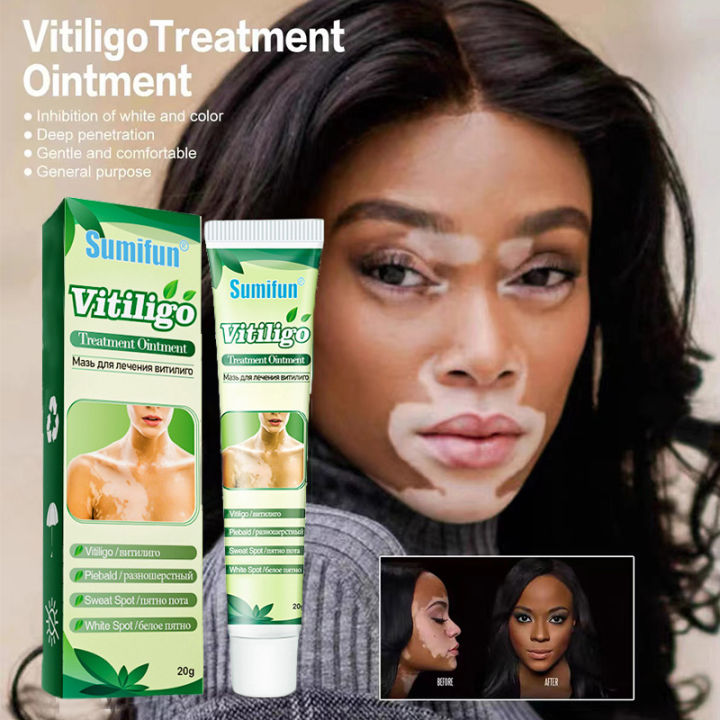 Vitiligo cream skin White spots Disease Treatment Ointment remove white ... Vitiligo cream skin White spots Disease Treatment Ointment remove white ...