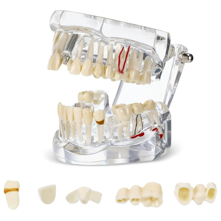 Teeth Model Dental Typodonts Implant Teeth Model with Removable Teeth ...