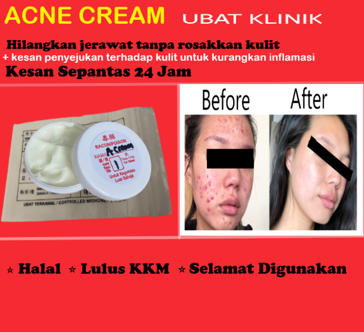 Krim Jerawat Acne Cream Fast Acting dengan Kesan Penyejukan Cooling ...