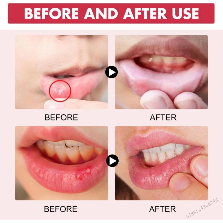 Relieve Swollen Gum Gel Sensitive Teeth Friendly Treatment Gel for ...