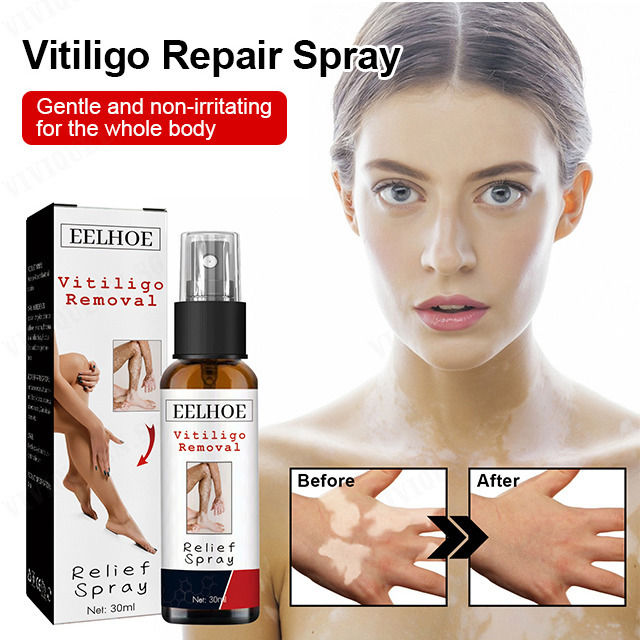 Herbal Vitiligo Repair Spray Skin Care | Lazada