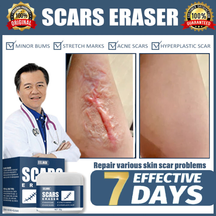 fix scar removal original scars remover for old scars scar gel by doc ...
