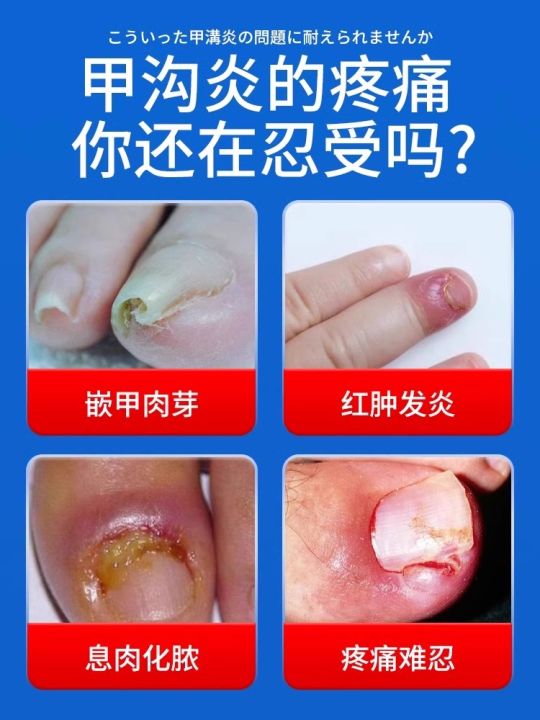 Special special ointment removing polyps paronychia, treating ...