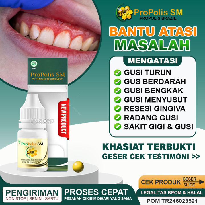 Obat Gusi Turun Merosot Gusi Menyusut Resesi Gingiva Periodontitis ...