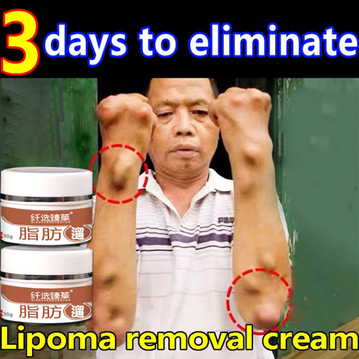 Effective Removal In 3 DaysQIANXUANZHENCAO Lipoma Removal Cream Effective Removal In 3 DaysQIANXUANZHENCAO Lipoma Removal Cream