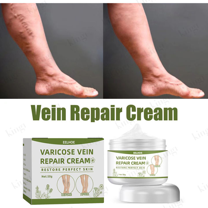 EELHOE Varicose Cream Effective Varicose Vein Treatment Original ...