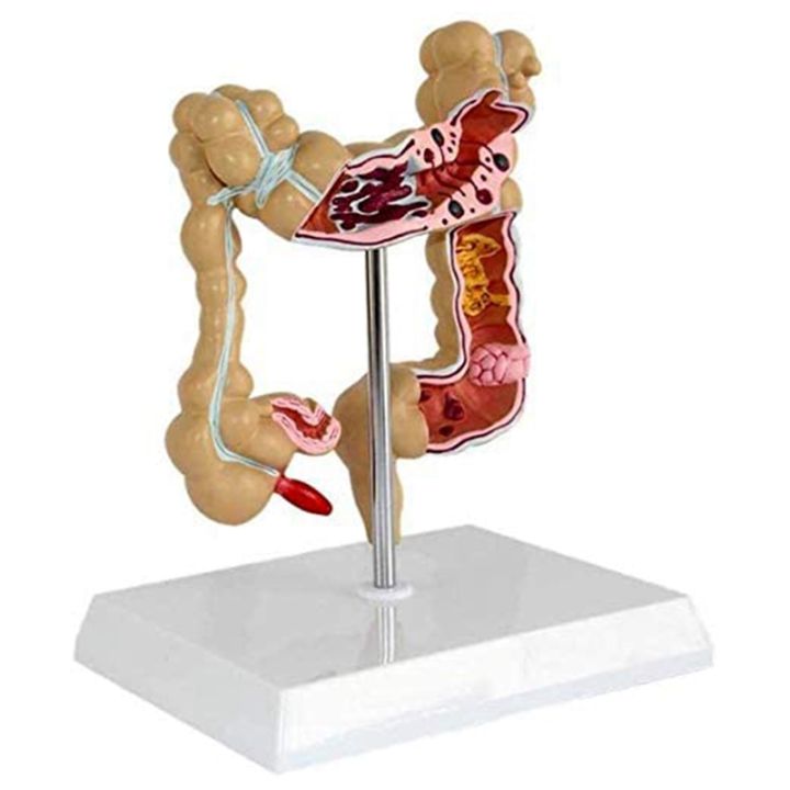 Colon Pathological Colorectal Cancer Model Large Intestine Model ...