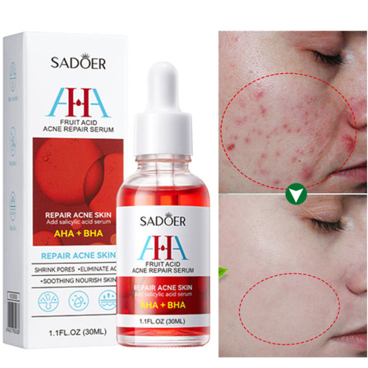 SADOER Salicylic Acid Acne Treatment Face Serum Fruit acids Essence Moisturizing Shrink Pores ...