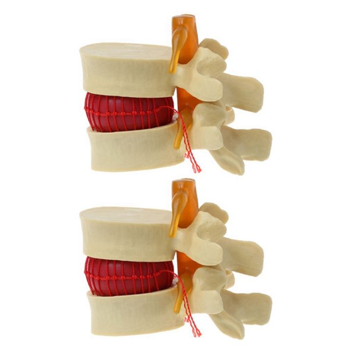 2X Lumbar Vertebrae Model Anatomical Spine Lumbar Disc Herniation ...