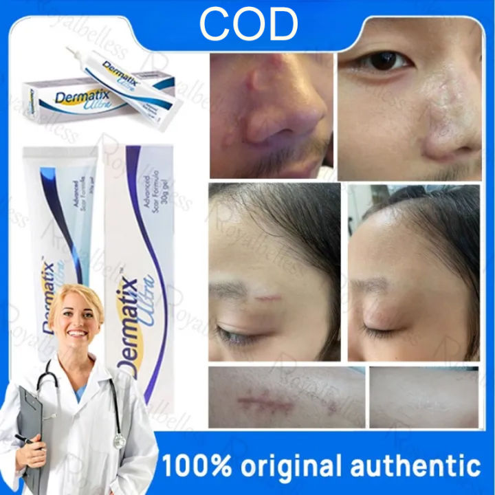 Dermatix Ultra Scar Gel 15g | Reduce Deep Scars & Post-surgery Scars ...
