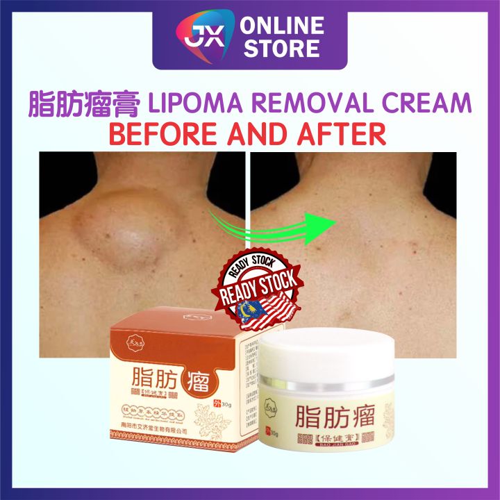 Herbal Lipoma Removing Cream Lipoma Health Cream Whole Body Fat Lump ...