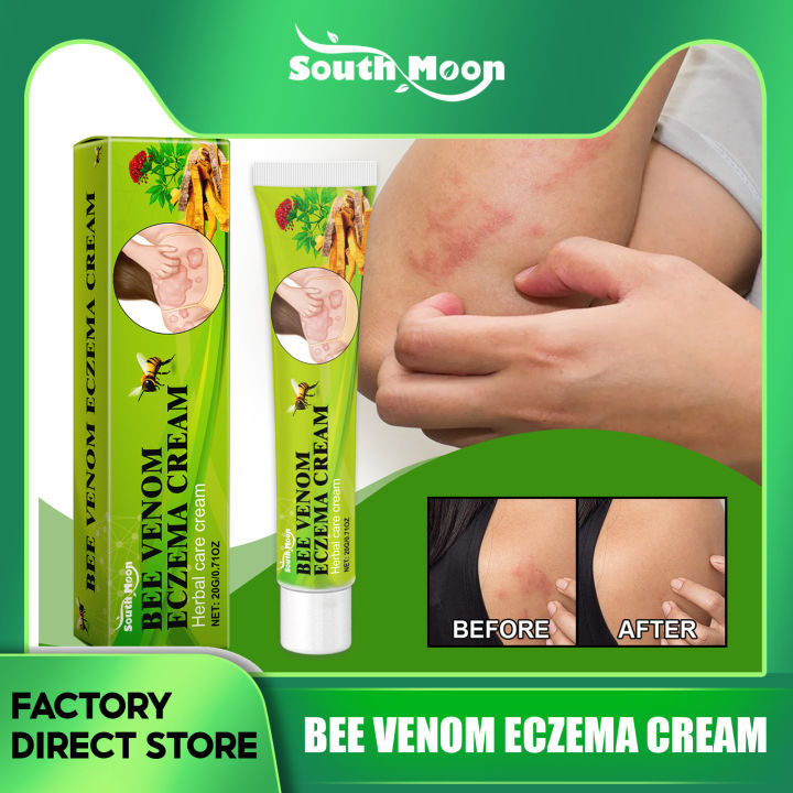 South Moon Bee Venom Psoriasis Cream Treatment Eczema Dermatitis Rash