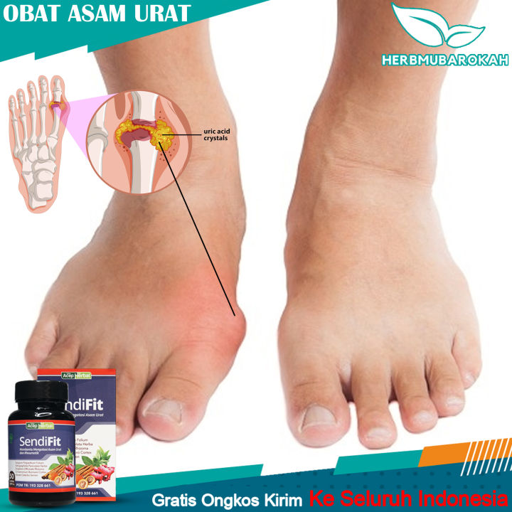 Obat Asam Urat - Sendi Bengkak - Pengapuran Tulang - Osteoporosis ...