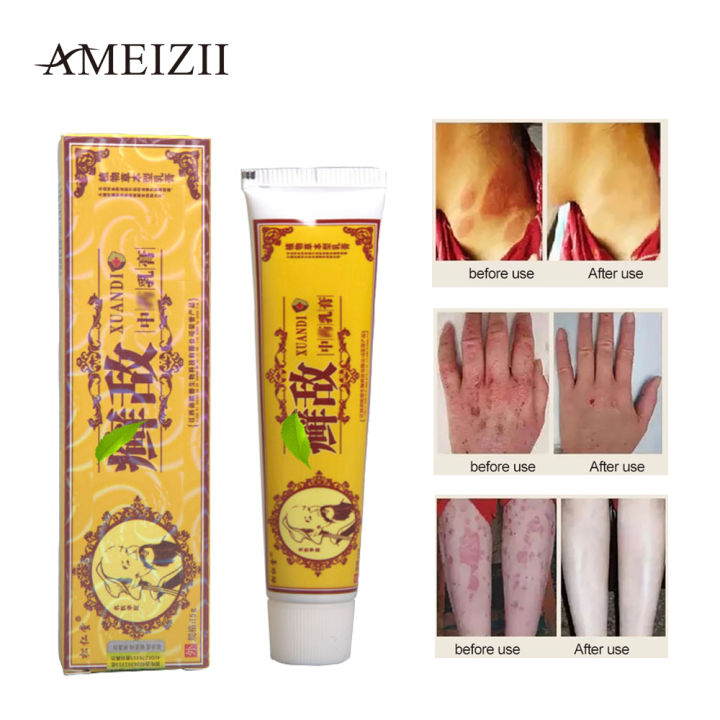 Psoriasis Eczema Cream Antifungal Antibacterial Itching Cream Eczema