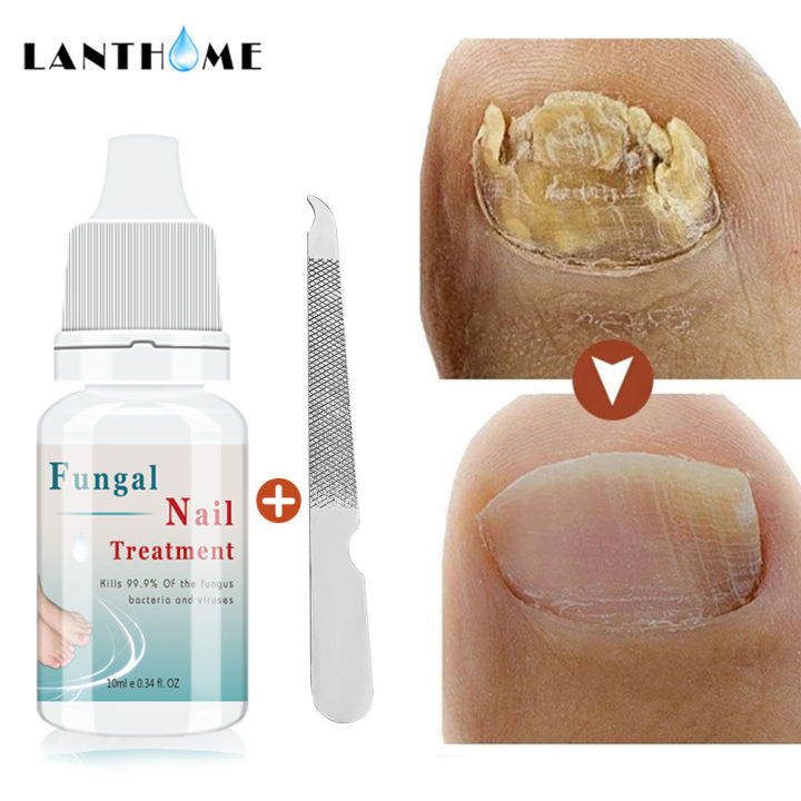 lanthome Nail Repair Essence Serum Fungal Nail Treatment Anti Fungal ...