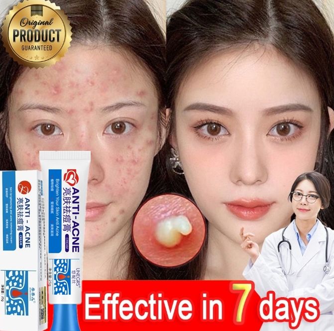 Acne Remover Cream Anti-Acne Cream Acne Treatment Gel Pimple Scars ...
