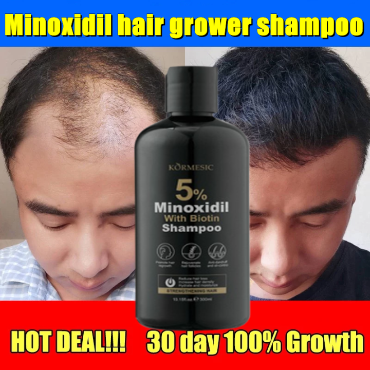 Minoxidil Hair Grower Shampoo Original Anti-Dandruff Anti Hair Loss ...
