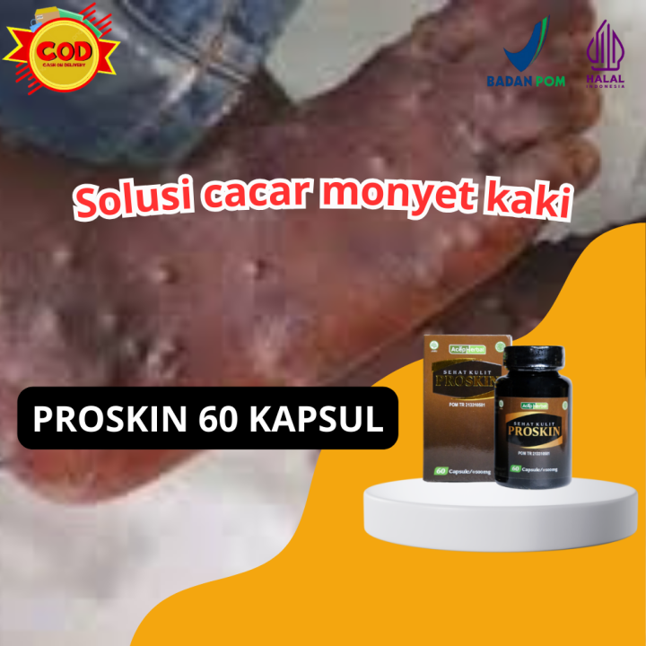 Obat Cacar Monyet Kaki, Benjolan Berisi Nanah, Muncul Lepuhan/luka,Ruam ...
