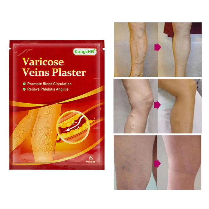 Effective Varicose Vein and Spider Vein Minimizer Patch Improve Blood ...
