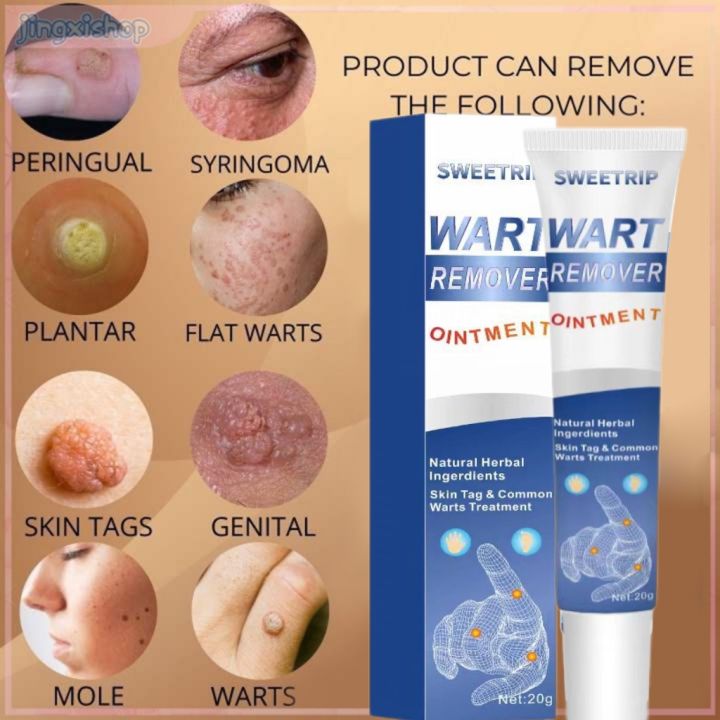 Warts Remover Original Cream 20g Warts Magic Remover Wartz Removal ...