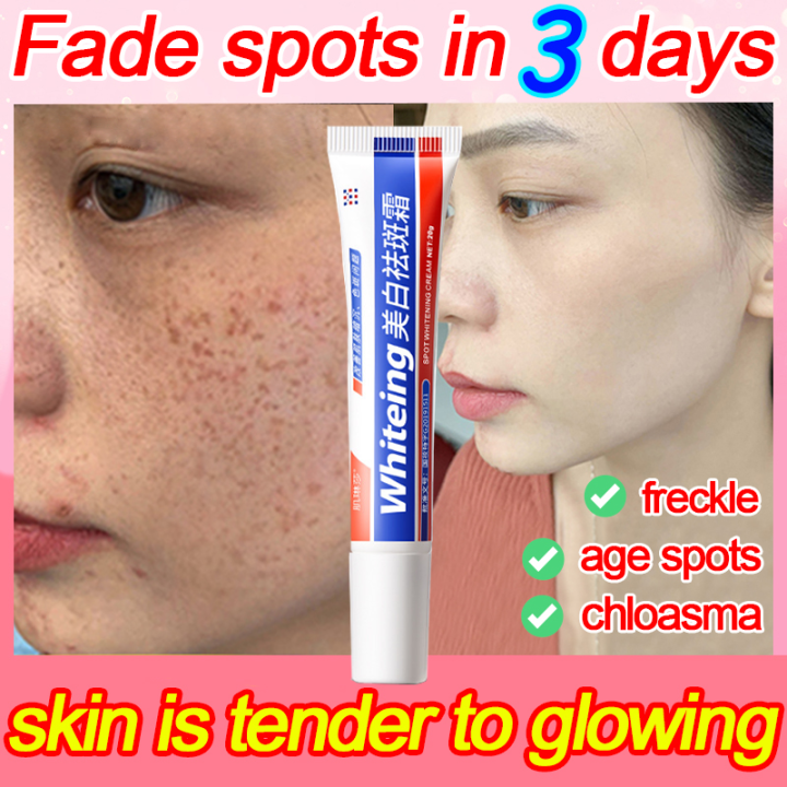 Pekas Remover 100% Effective and Original Whitening Freckle Cream 20g ...