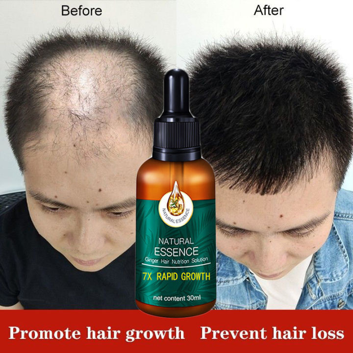100 Natural Ginger Hair Serum Hair Grower Fast Long Hair Treatment