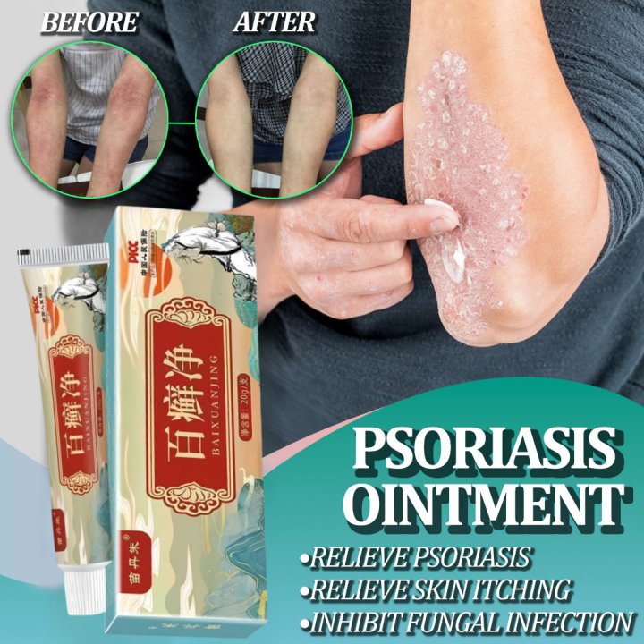 100% Effective Herbal Psoriasis Cream 20g Dermatitis Eczema Cream Atoderma Skin Pruritus Herbal ...