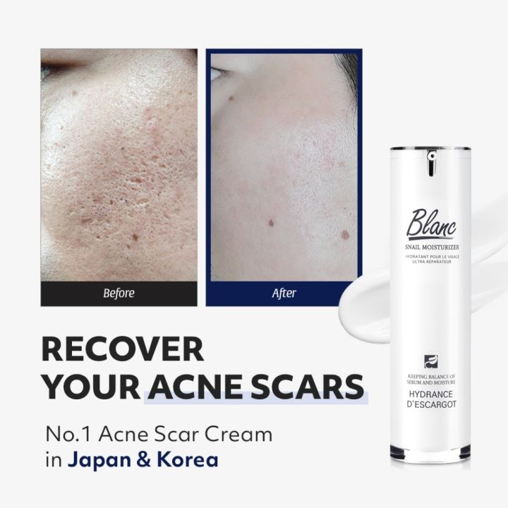 Blanc Nature Official Acne Scar Cream Centella Snail Moisturizer Pimple Acne Treatment 50ml Lazada Lazada