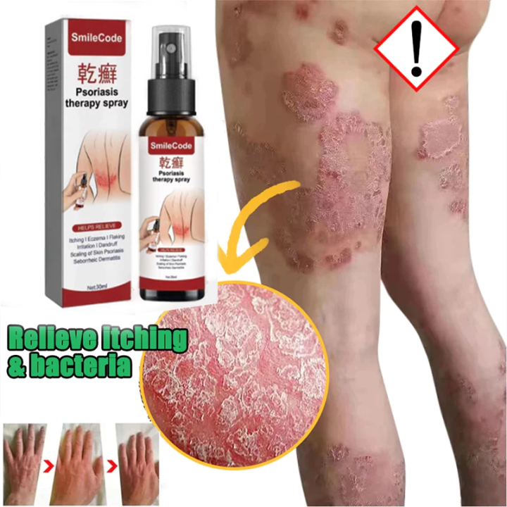 Psoriasis Treatment Spray Eczema Dermatitis Inhibit Scaly Plaques Hands ...