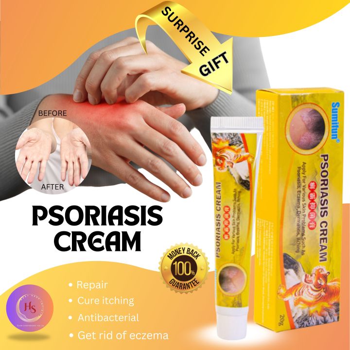 Psoriasis Cream Dermatitis Eczematoid Eczema Pruritus Ointment ...