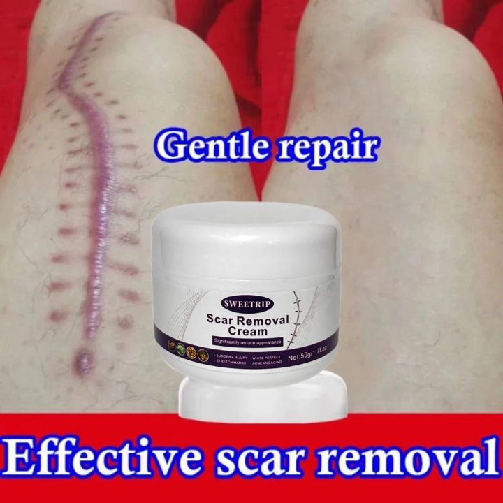 SWEETRIP Scar Remover Cream Peklat Remover Cream for Old Scars Stretch ...
