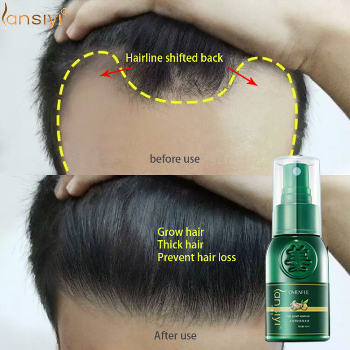 Hair treatment Promote hair growth Anti-hair loss spray Stabilize hair ...