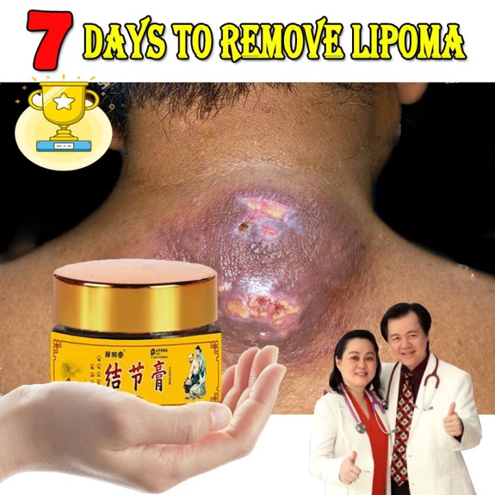 bukol cream lipoma cream 2.0 japan herbal cream gamot ganglion cyst ...