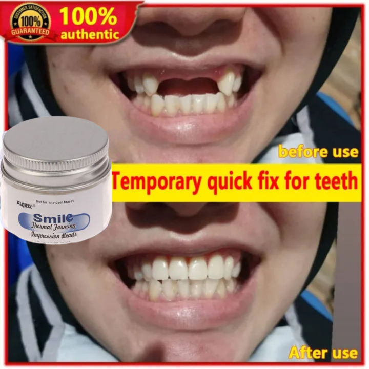 Gigi Palsu Temptooth Temporary Tooth / Gigi Palsu Penambal Ompong ...