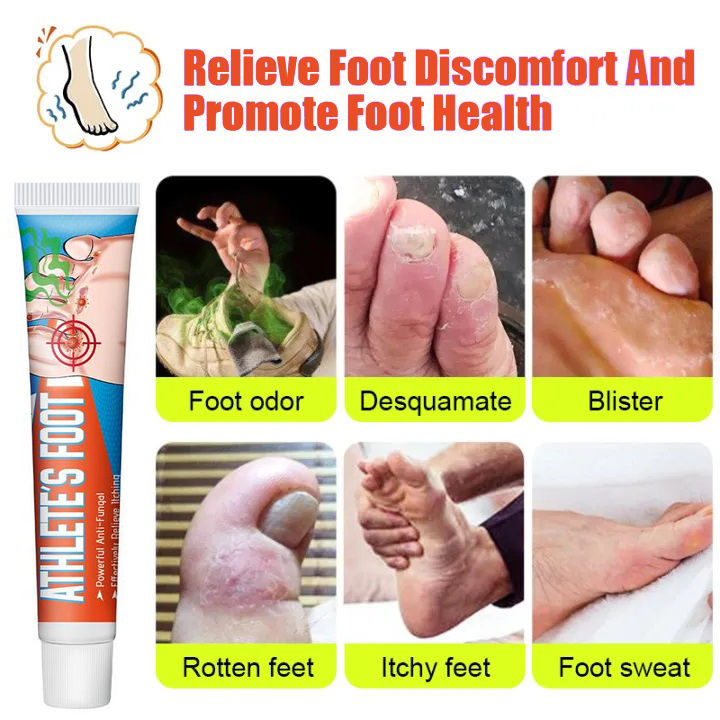 Anti-Fungal Treatment Cream Beriberi Cream Peeling Remove Foot Ringworm ...