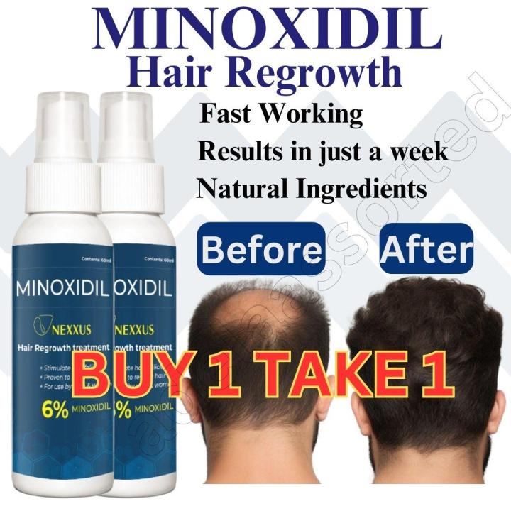 Minoxidil 6% 60ml Hair Grower Men and Women Natural Topical Solution | Lazada PH