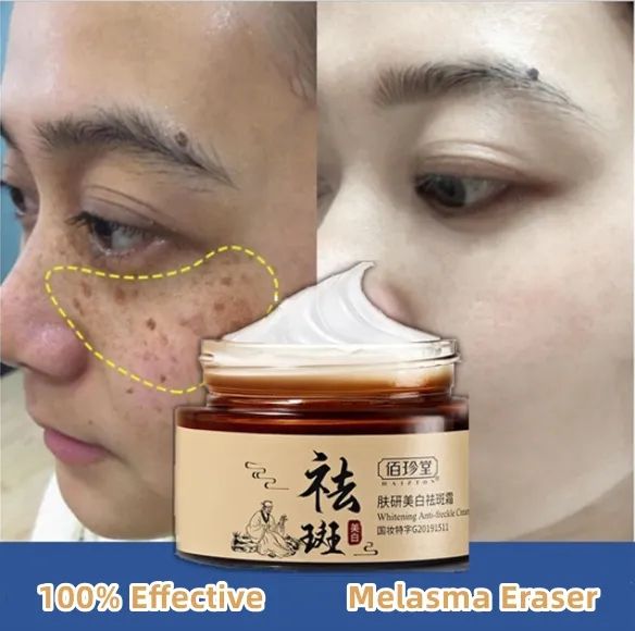 Melasma Cream Yunnan Herbal Whitening Freckle Cream Melasma Cream ...